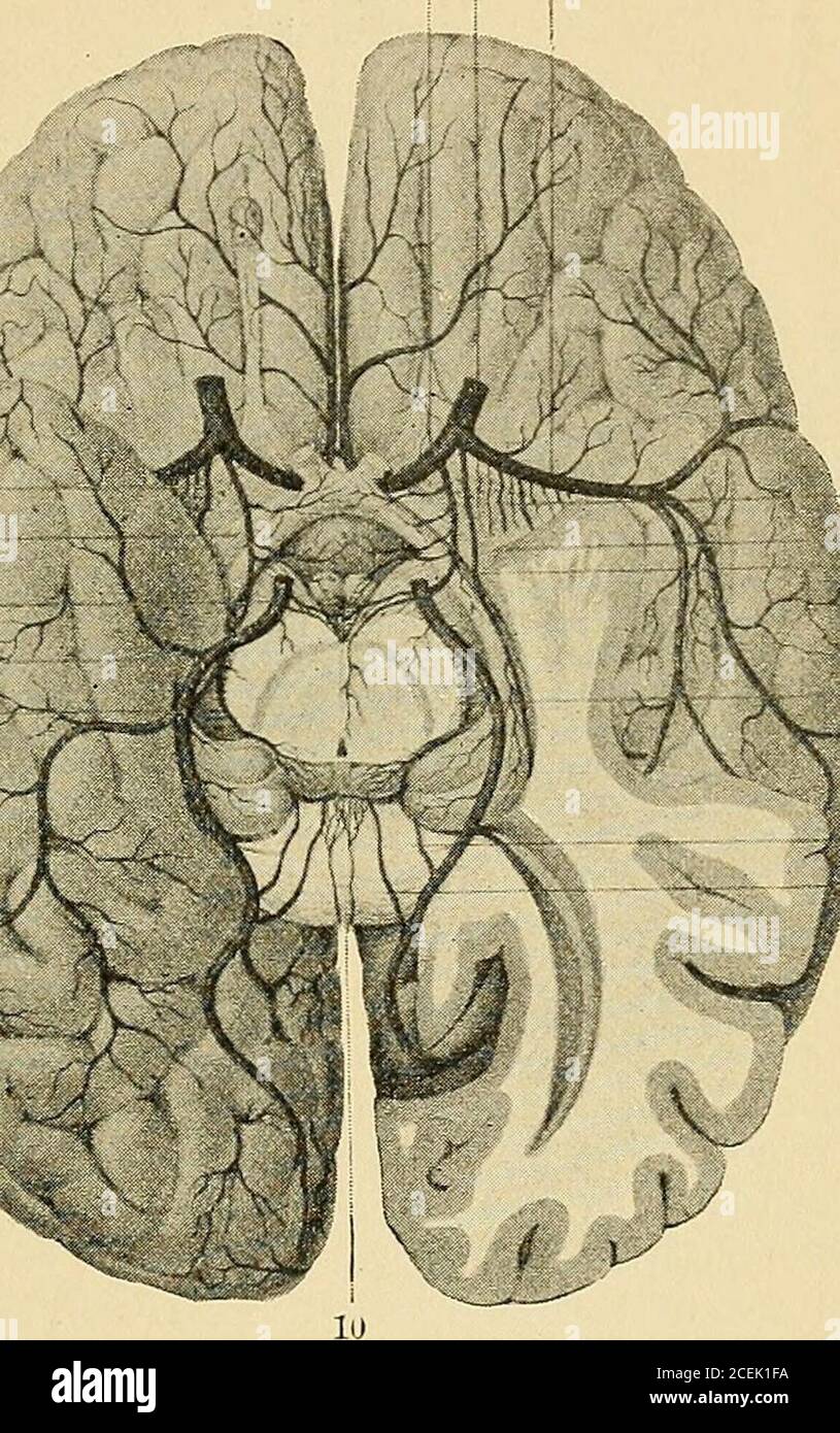 Intra cranial hi-res stock photography and images - Alamy