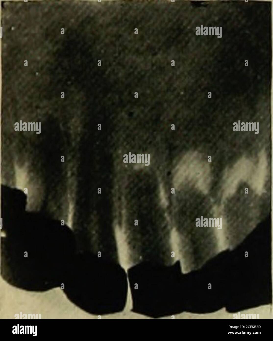 . Insomnia and nerve strain. Case 2.—Insomnia. Alveolar Case 4 ...