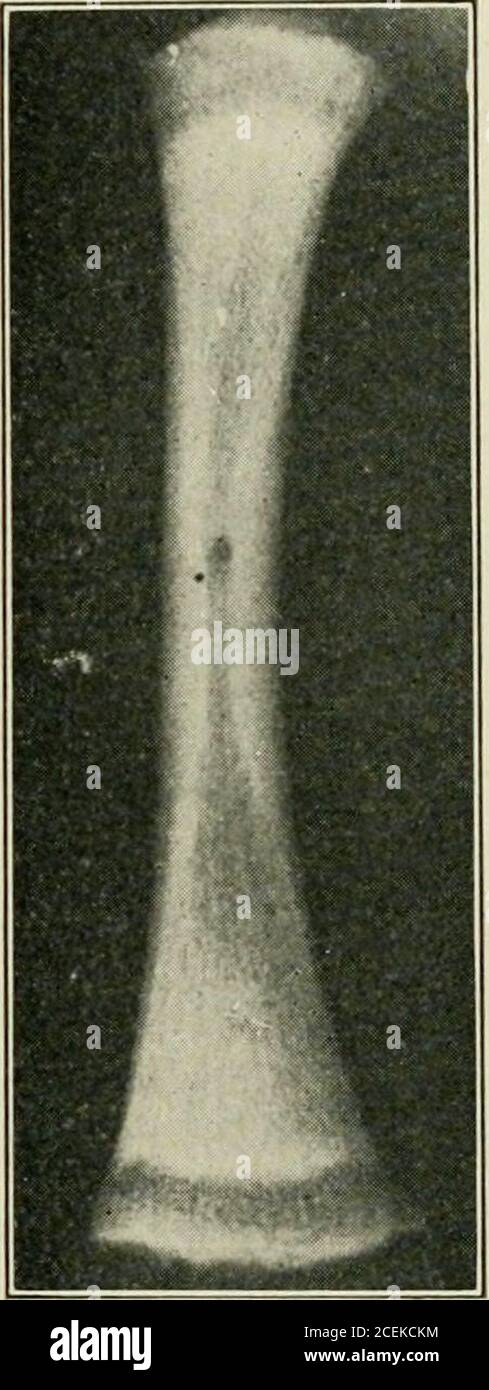 . Obstetrics for nurses. Fig. 160.—X-ray photograph ofnormal bone. Fig ...