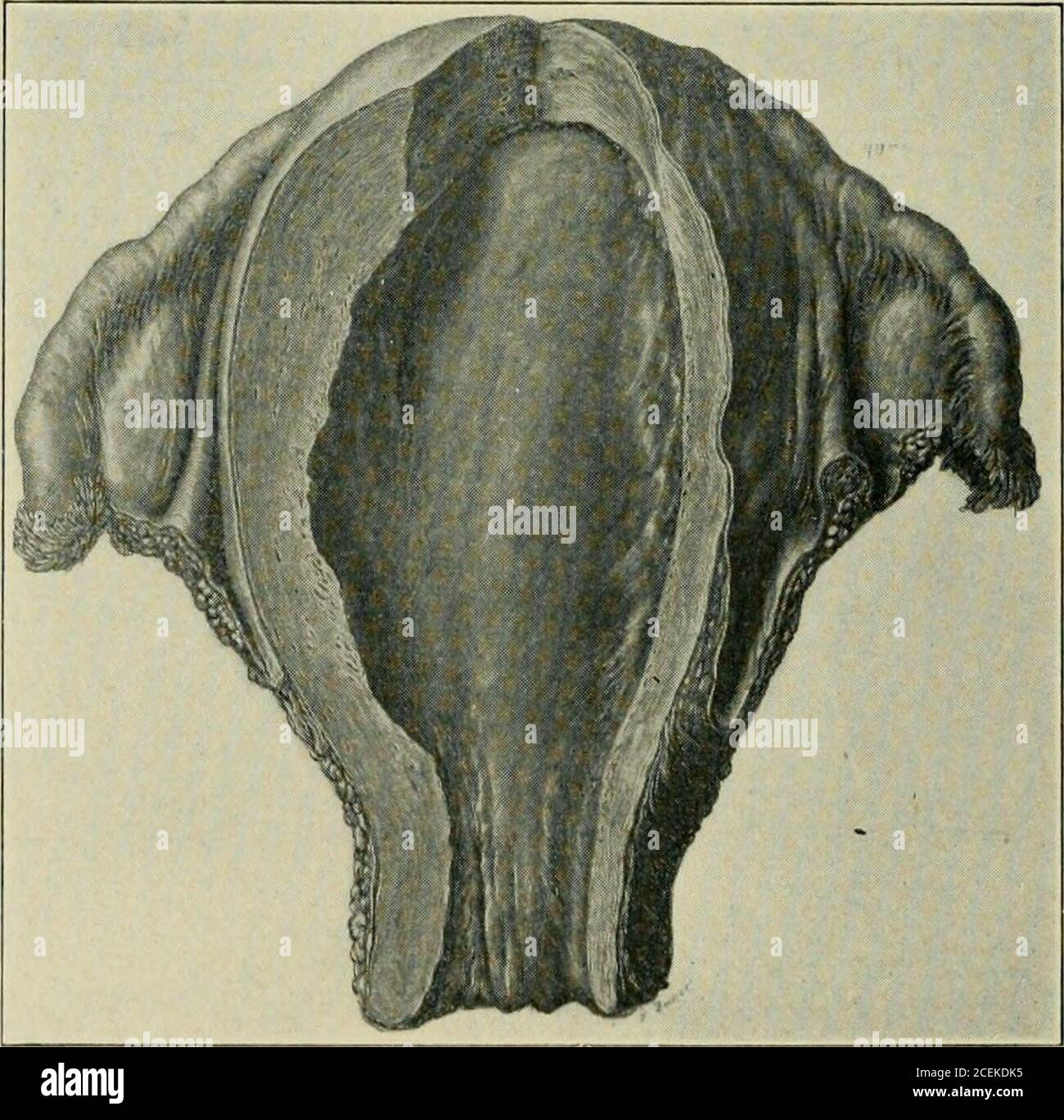 Uterine Infection Discharge Signs Of An Intrauterine Infection