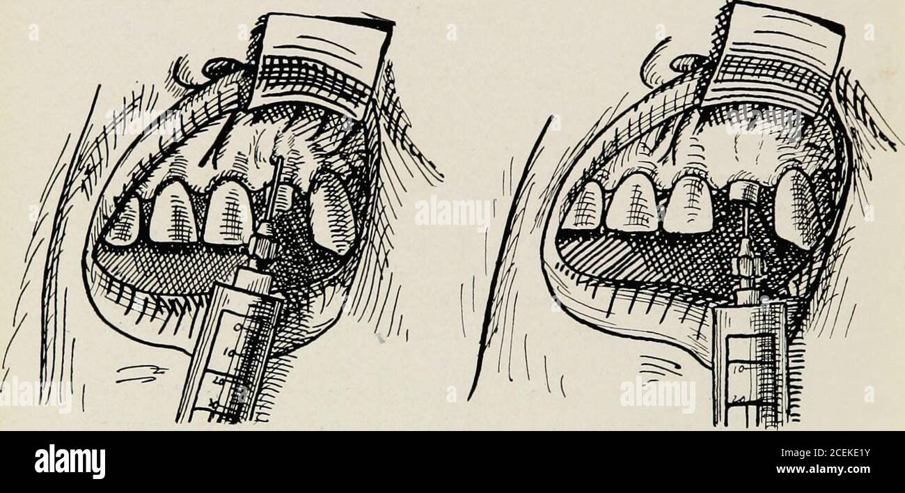 . Oral anaesthesia; local anaesthesia in the oral cavity, technique and ...