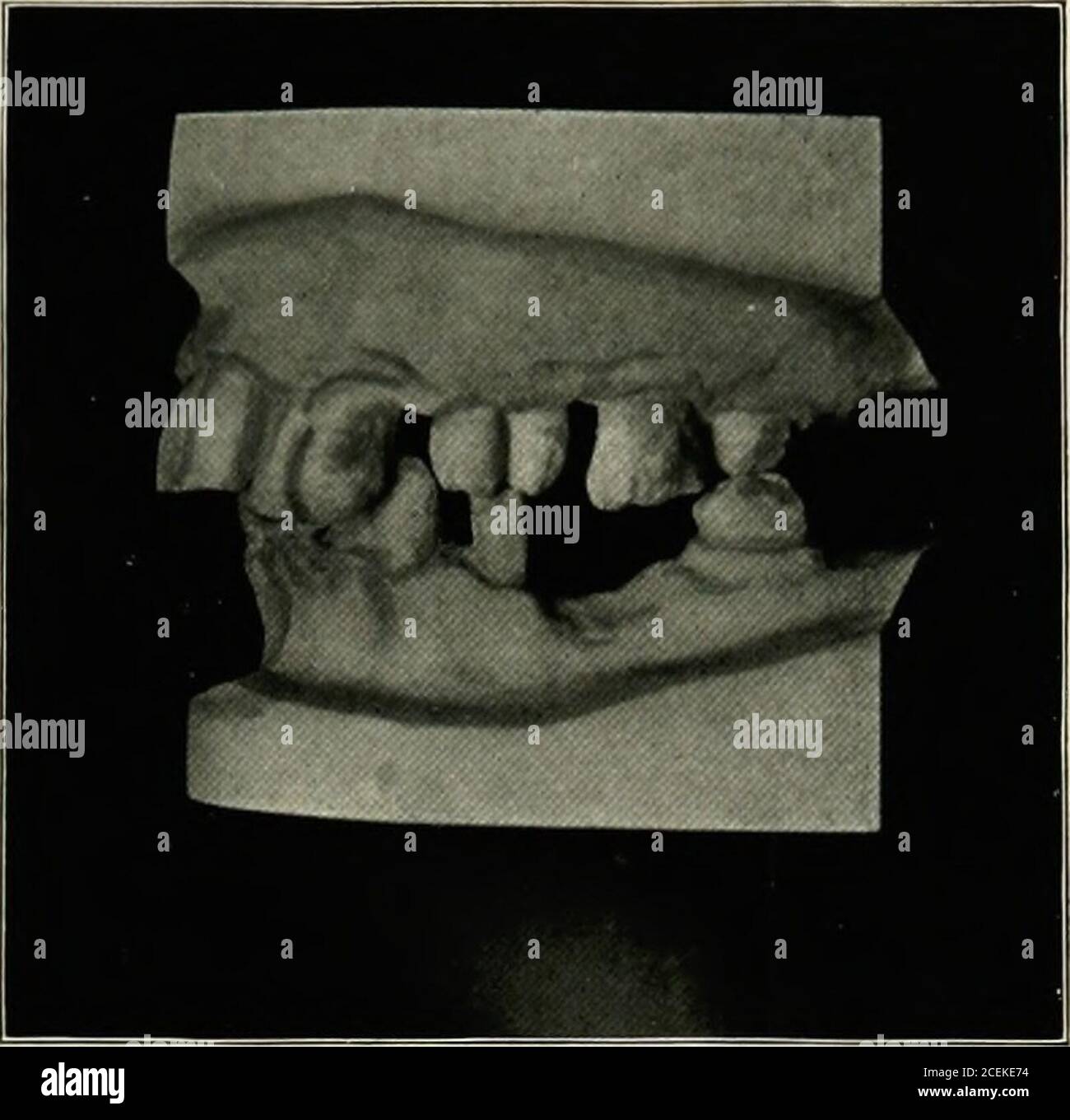 Maxillary molar hi-res stock photography and images - Alamy
