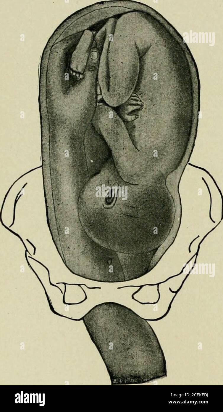 . Obstetrics for nurses. -indicatedin contracted pelvis, since thehead ...