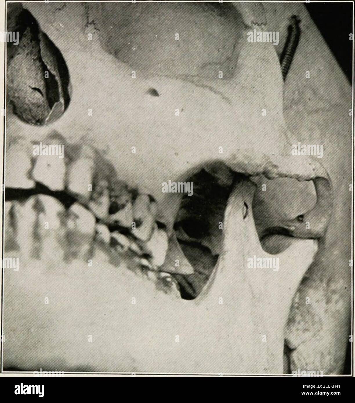 Ramus of mandible hi-res stock photography and images - Alamy