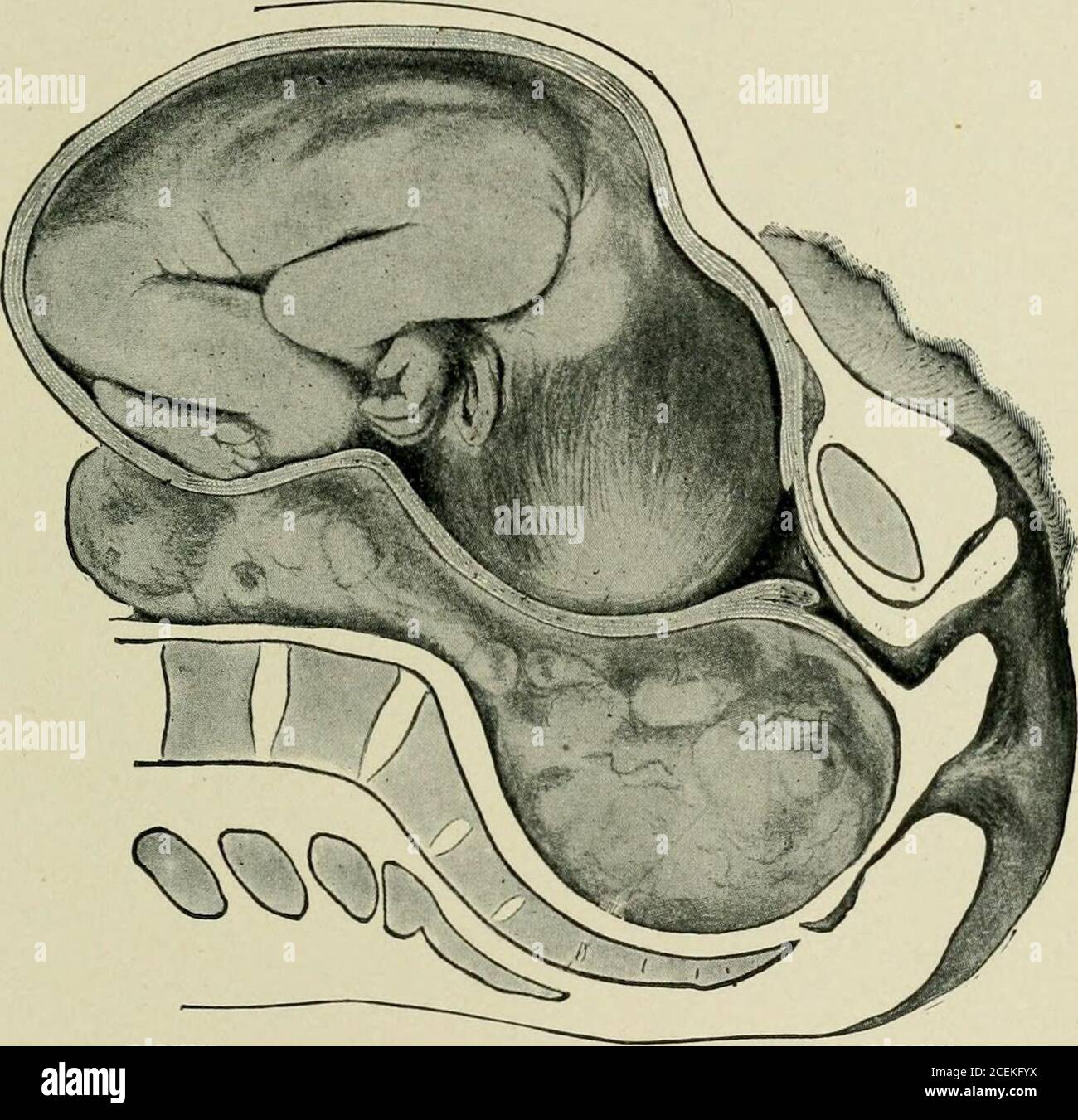 . Obstetrics for nurses. the only pro-cedure by which the child can be ...