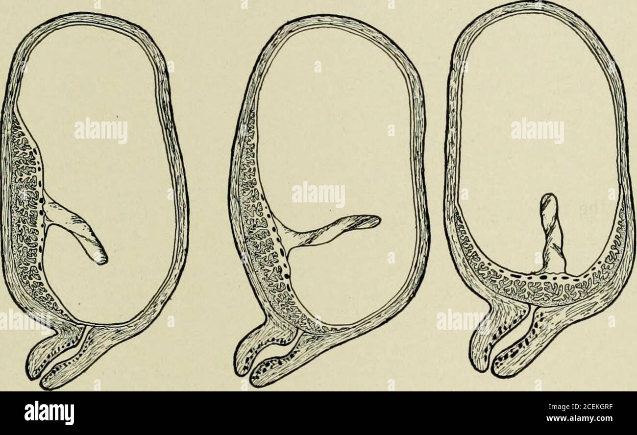 Partial placenta previa hi-res stock photography and images - Alamy