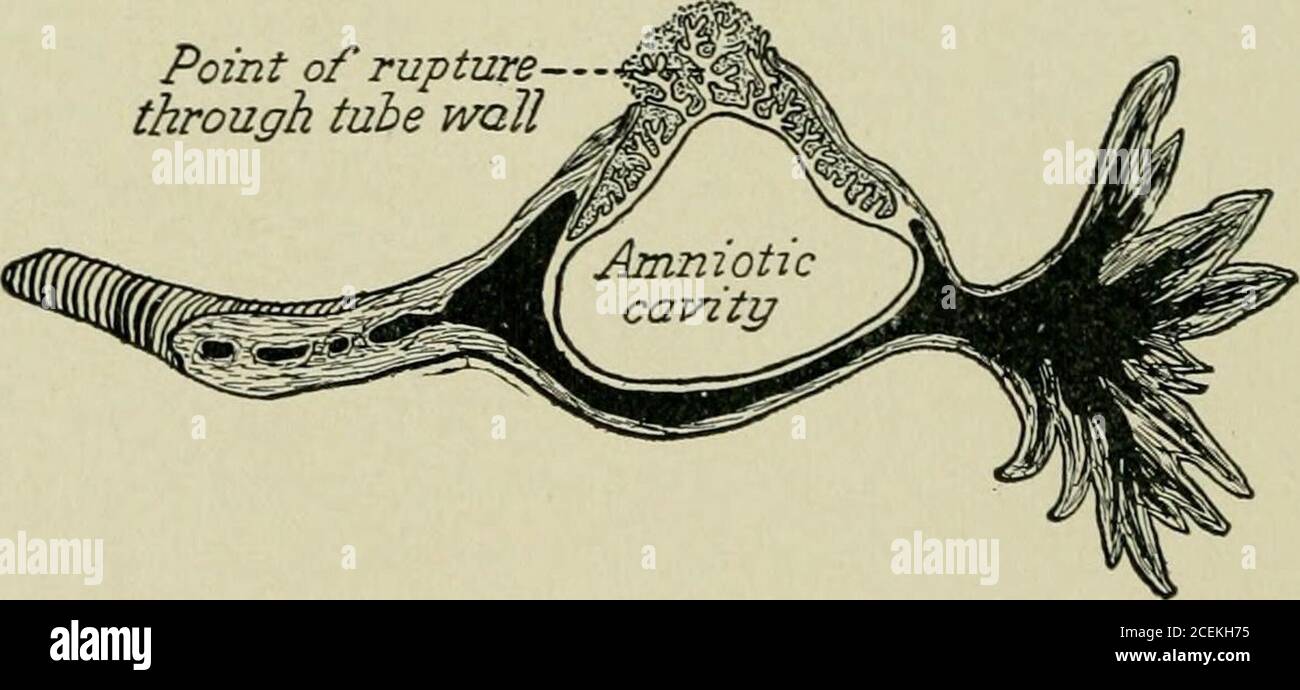 . Obstetrics for nurses. Fig. 108.—Schematic diagram of tubal abortion ...