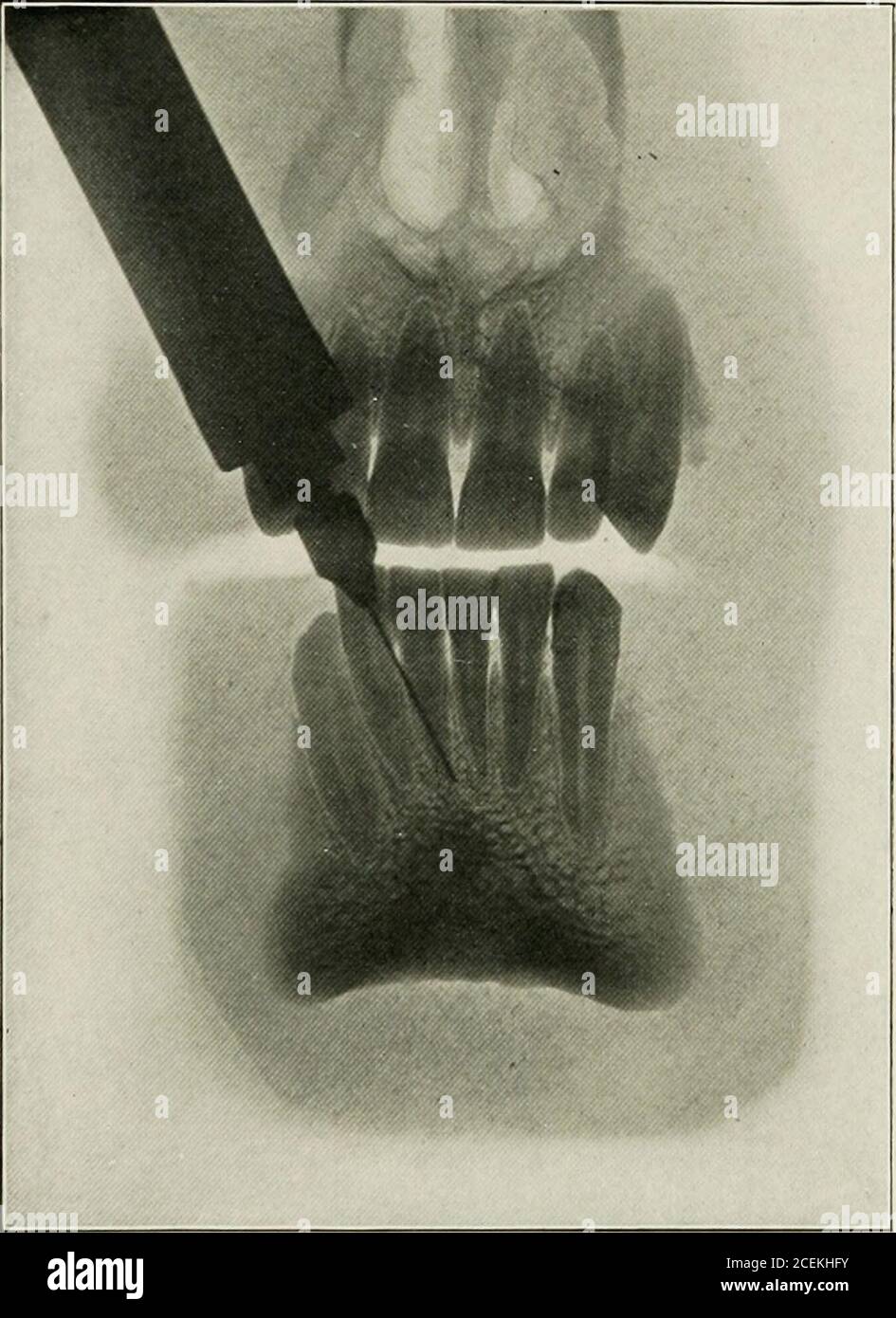 Palatal injection hi-res stock photography and images - Alamy