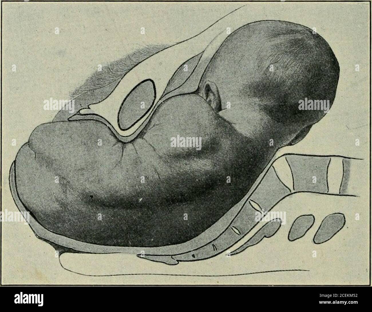 Caput succedaneum hi-res stock photography and images - Alamy