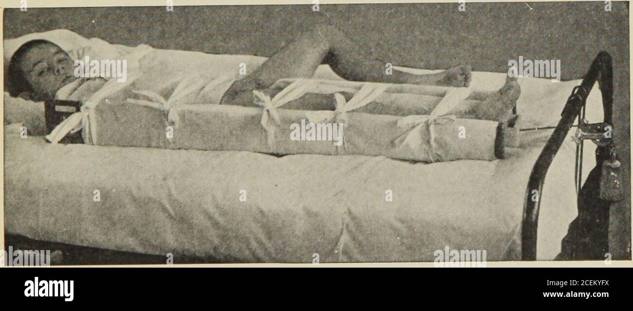 Femur fracture with surgical fixation hi-res stock photography and ...