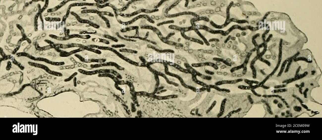 . The bacteriology of the eye. Fig. 69.—Keratomycosis Aspergillina ...