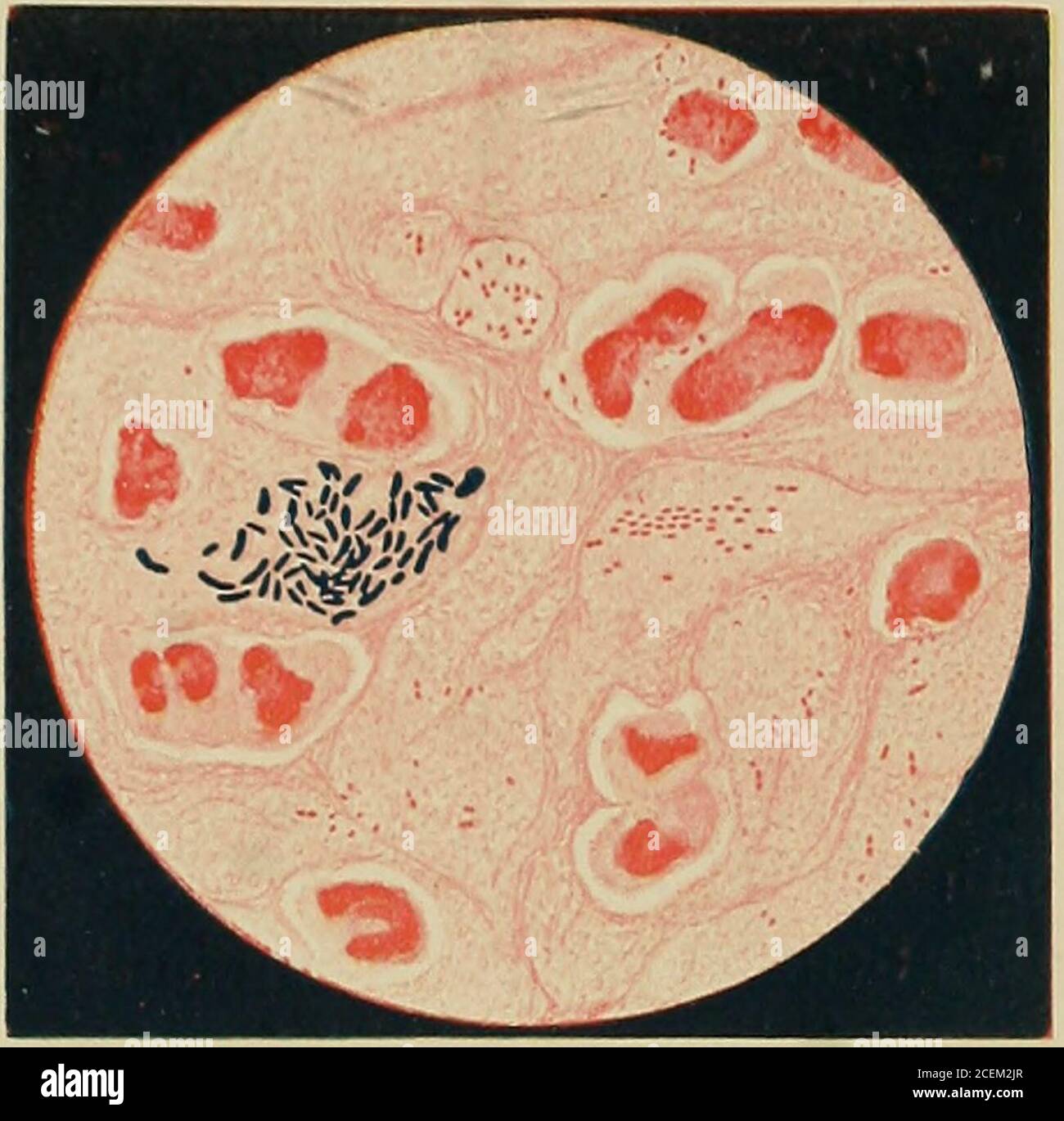 Corynebacterium Xerosis Acid Fast