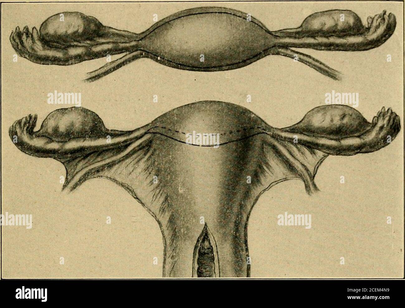 . Pelvic inflammation in women. Fig. 6o.—Showing the Extent of the ...