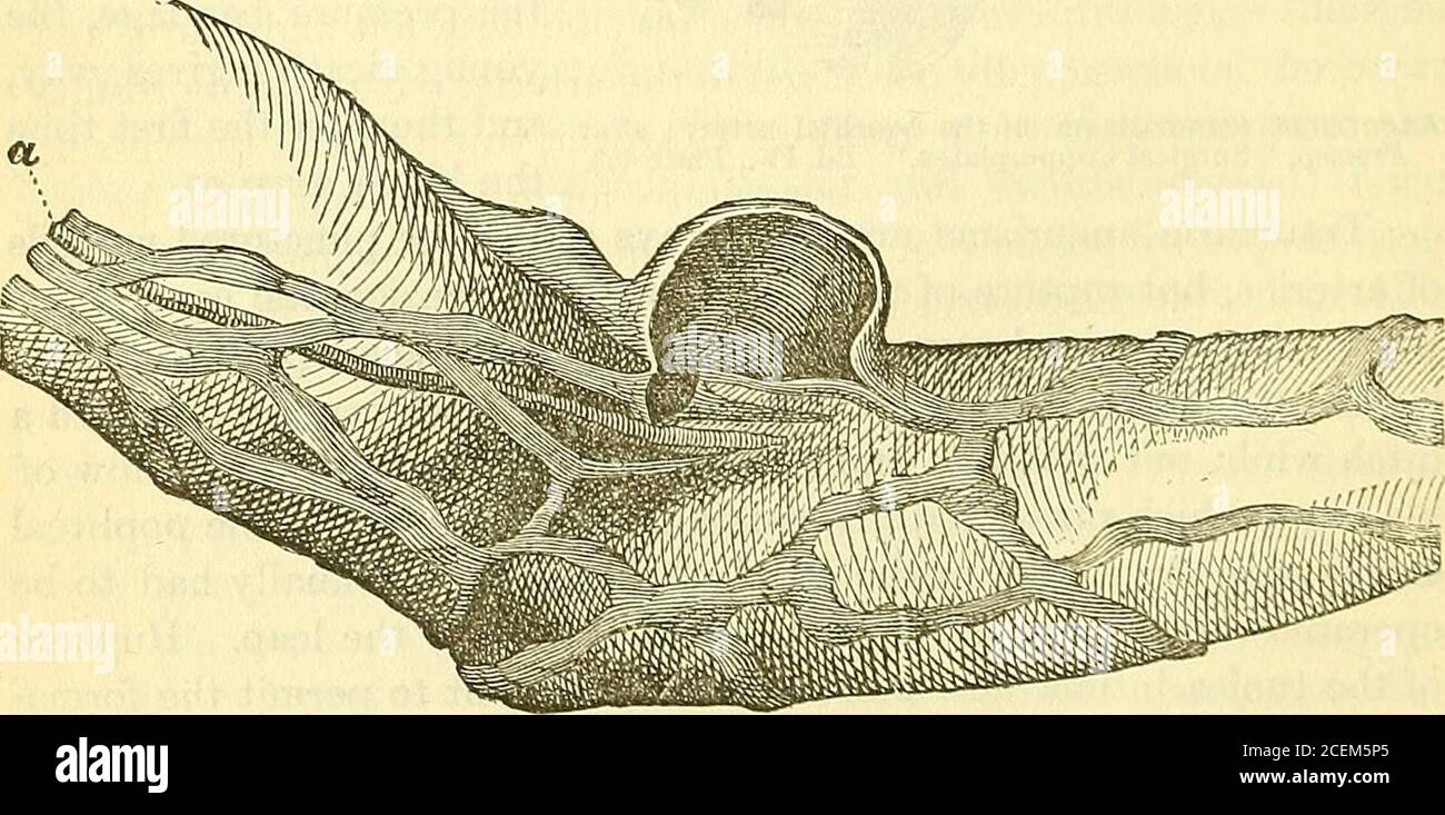 Venesection hi-res stock photography and images - Alamy