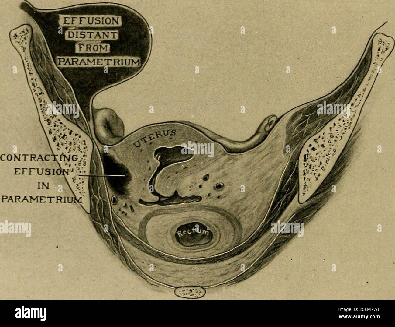 Parametrium Definition
