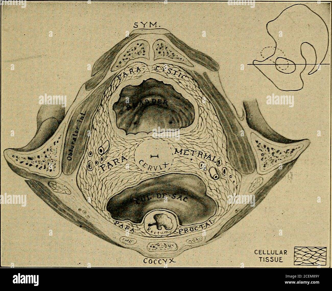. Pelvic inflammation in women. sheets and ligamentary planes. The sub ...