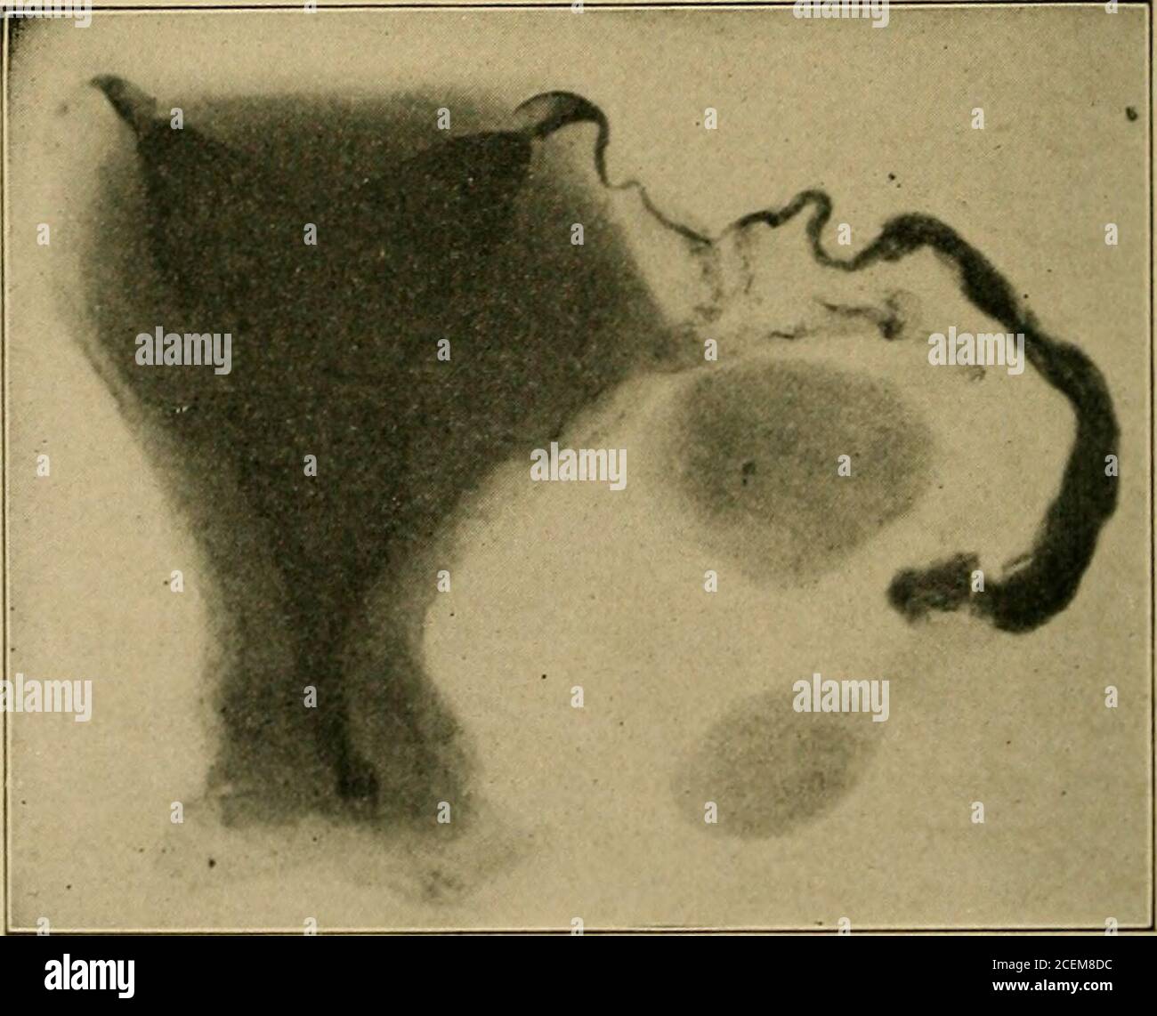 . Pelvic inflammation in women. Fig. 26.—Barium Injected into the ...