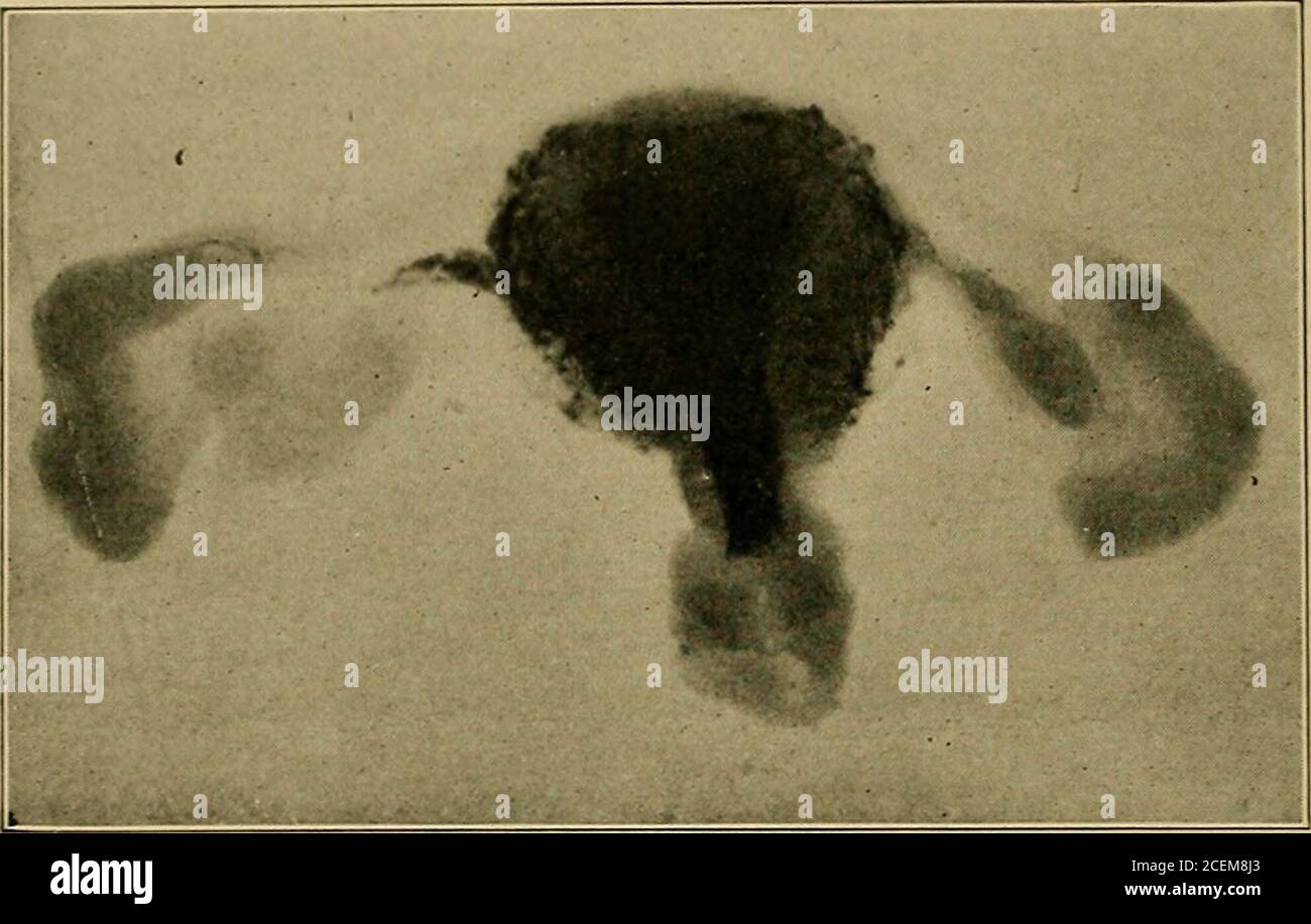. Pelvic inflammation in women. gland epi-thelium, which proliferates ...