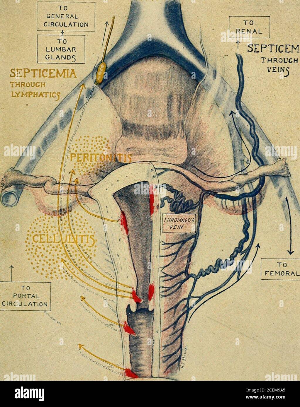 . Pelvic inflammation in women. , the uterus is normally sterile; but ...