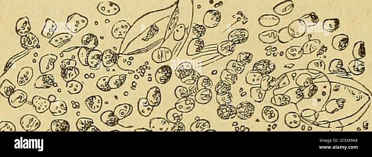 . Lehrbuch der Frauenkrankheiten. Vaginaler Fluor albus unter dem ...