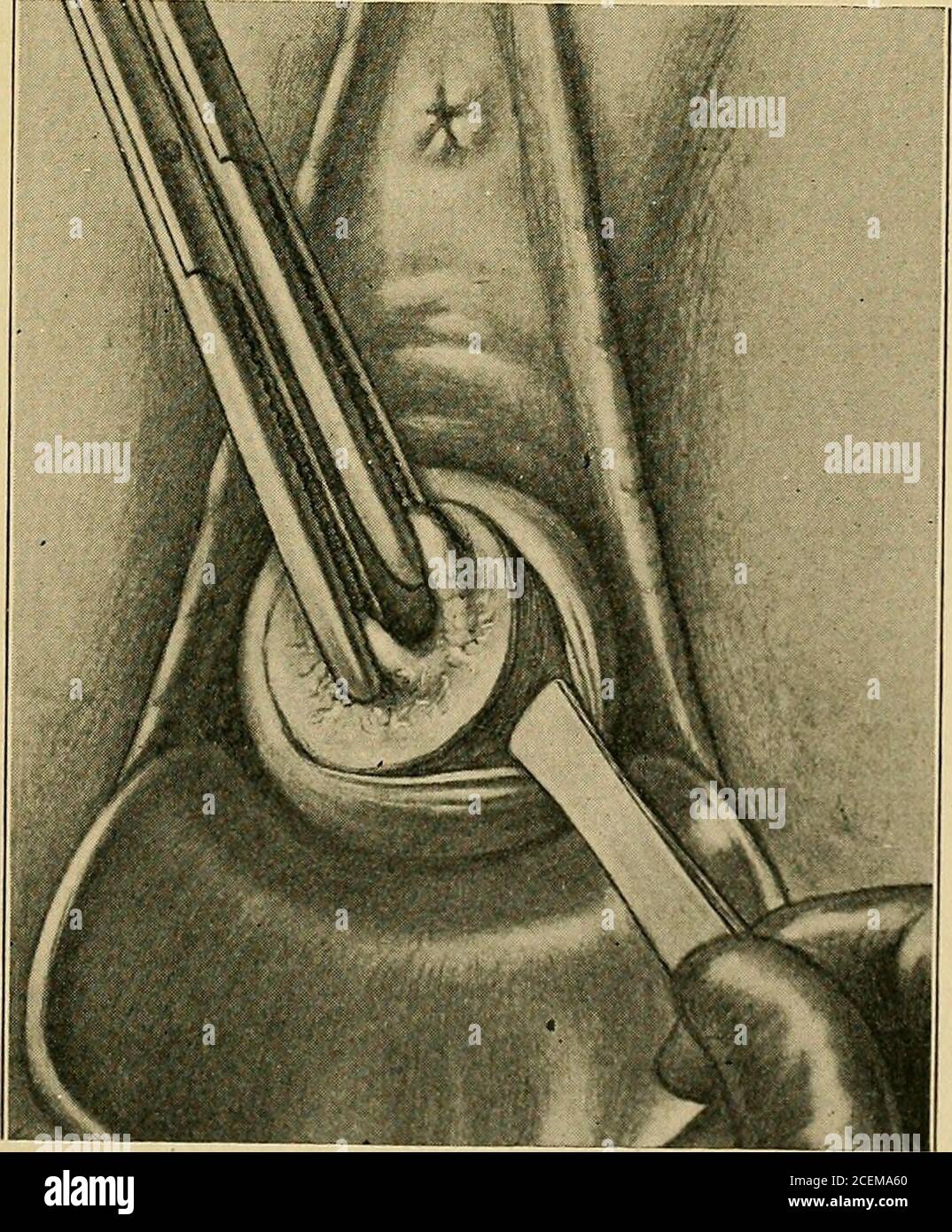 Cervical incision hi-res stock photography and images - Alamy