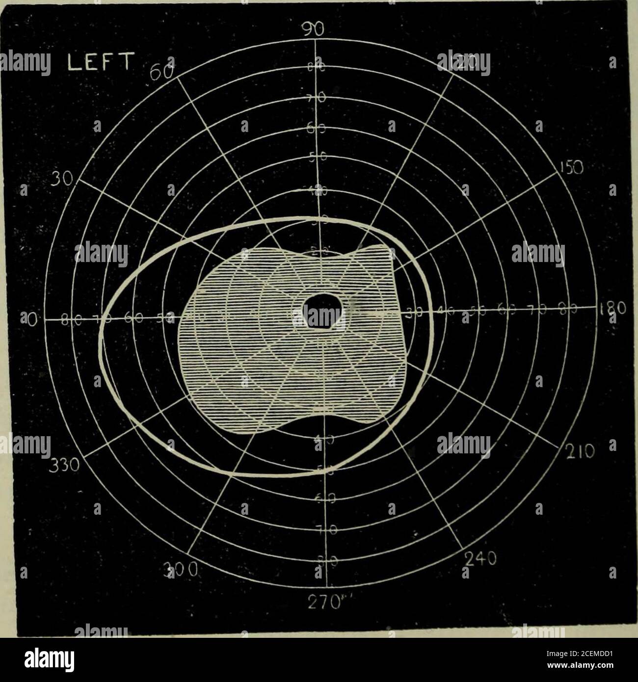 Central scotoma hi-res stock photography and images - Alamy