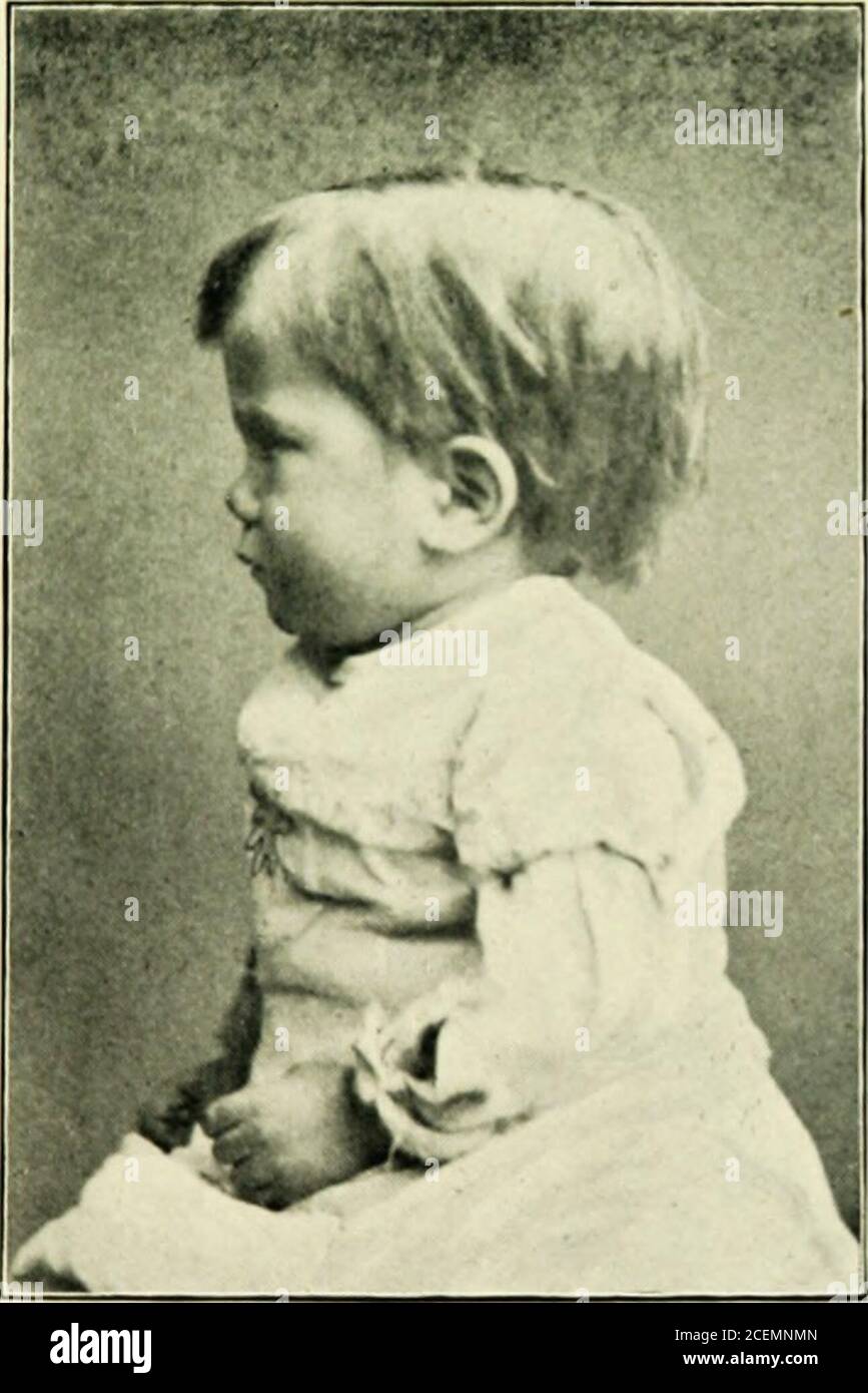 Hydrocephalic condition hi-res stock photography and images - Alamy