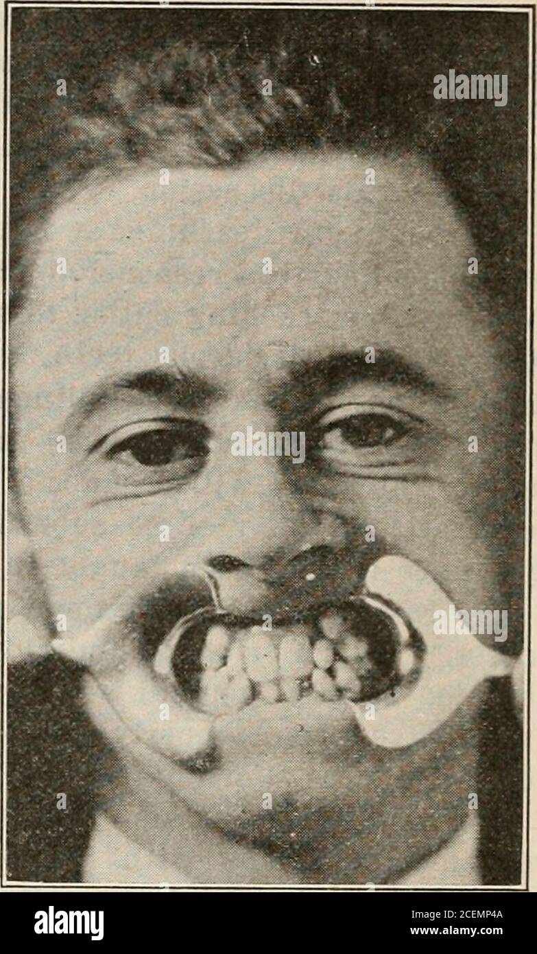 facial disproportion