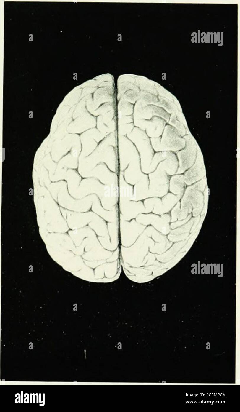 . The mental affections of children : idiocy, imbecility and insanity ...