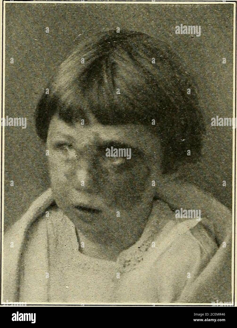 Cutaneous angioma hi-res stock photography and images - Alamy