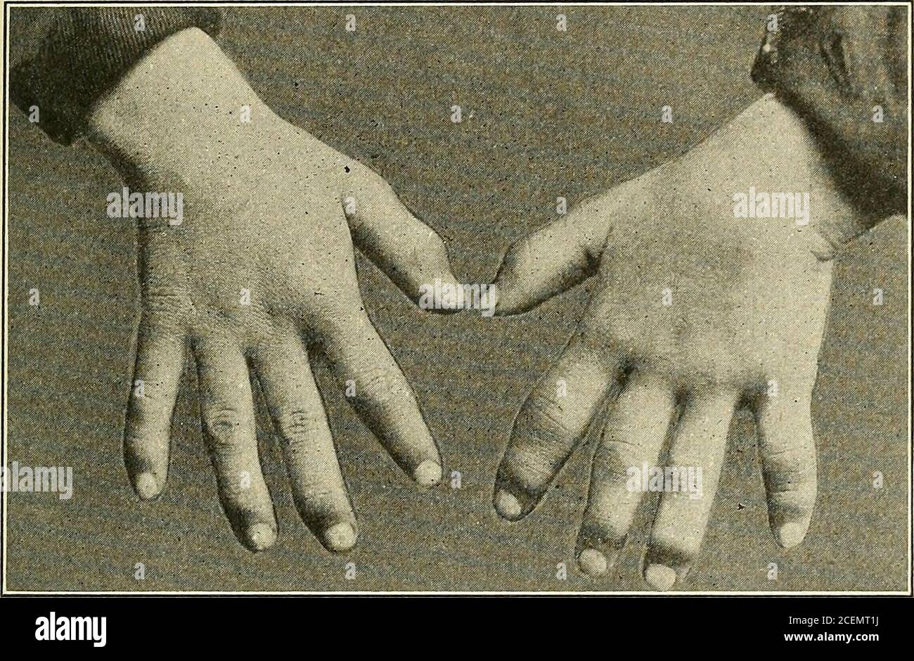 Necrosis finger hi-res stock photography and images - Alamy