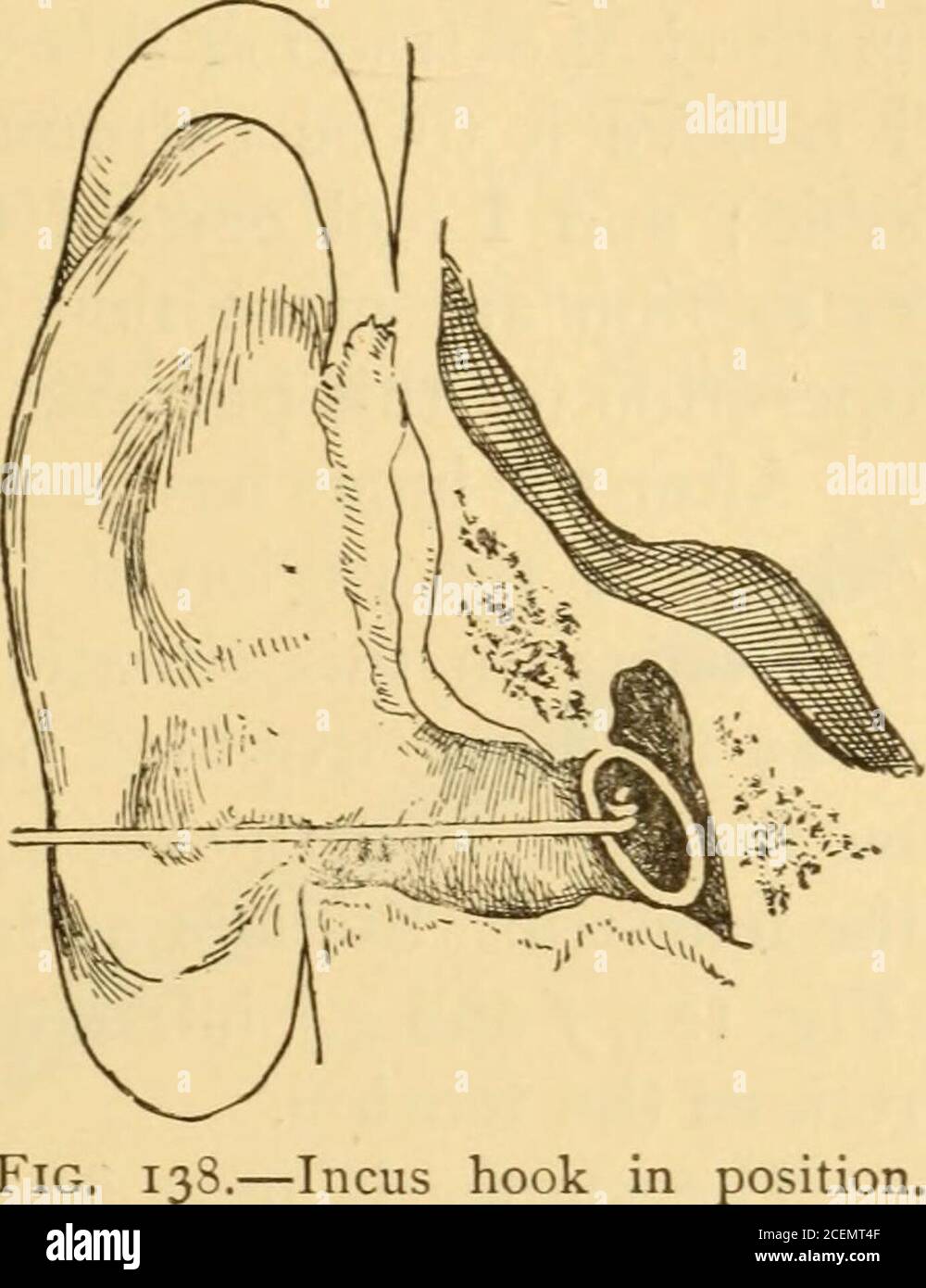 Ear Hook High Resolution Stock Photography and Images - Alamy
