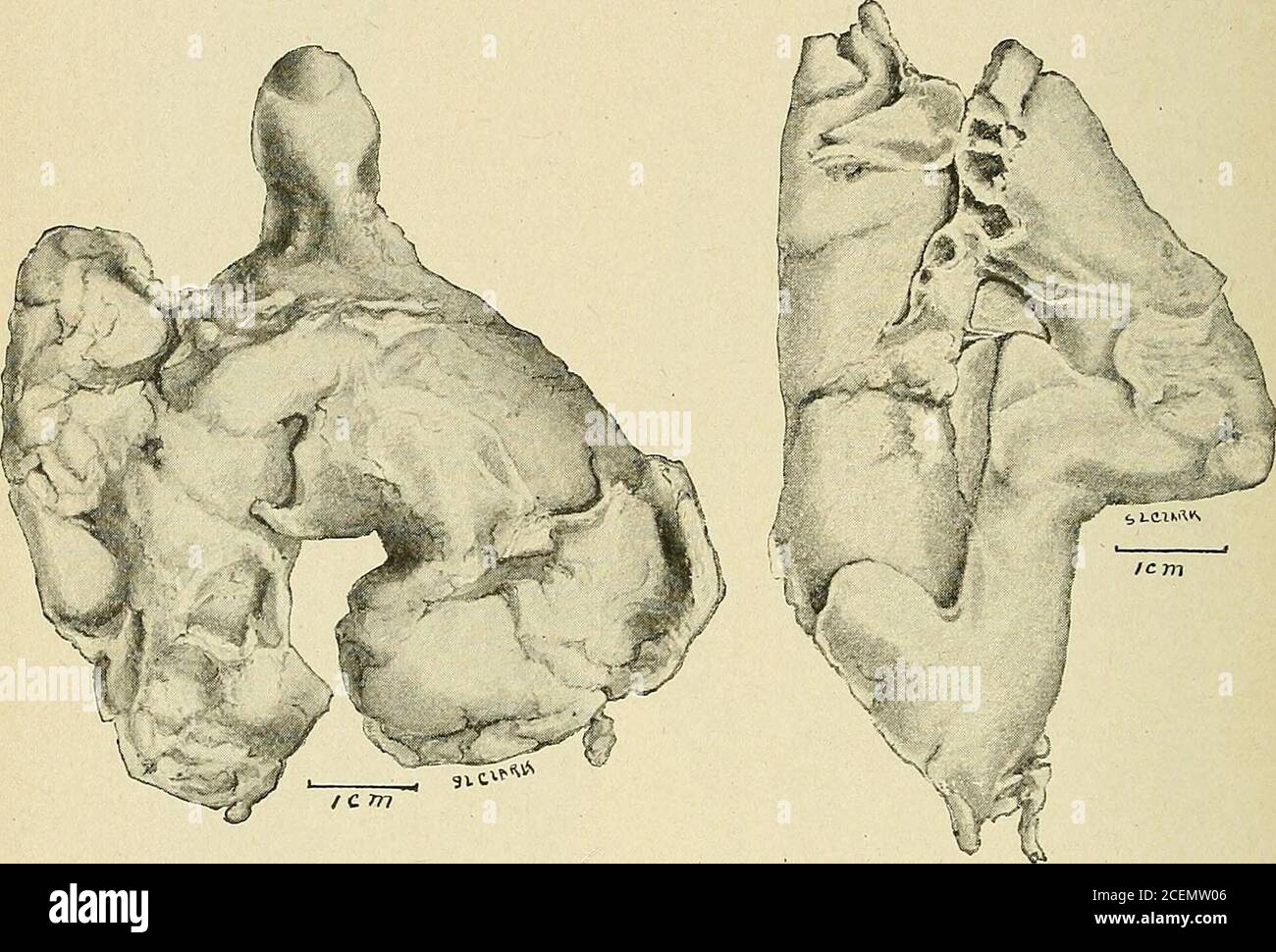 Suprasternal notch hi-res stock photography and images - Alamy