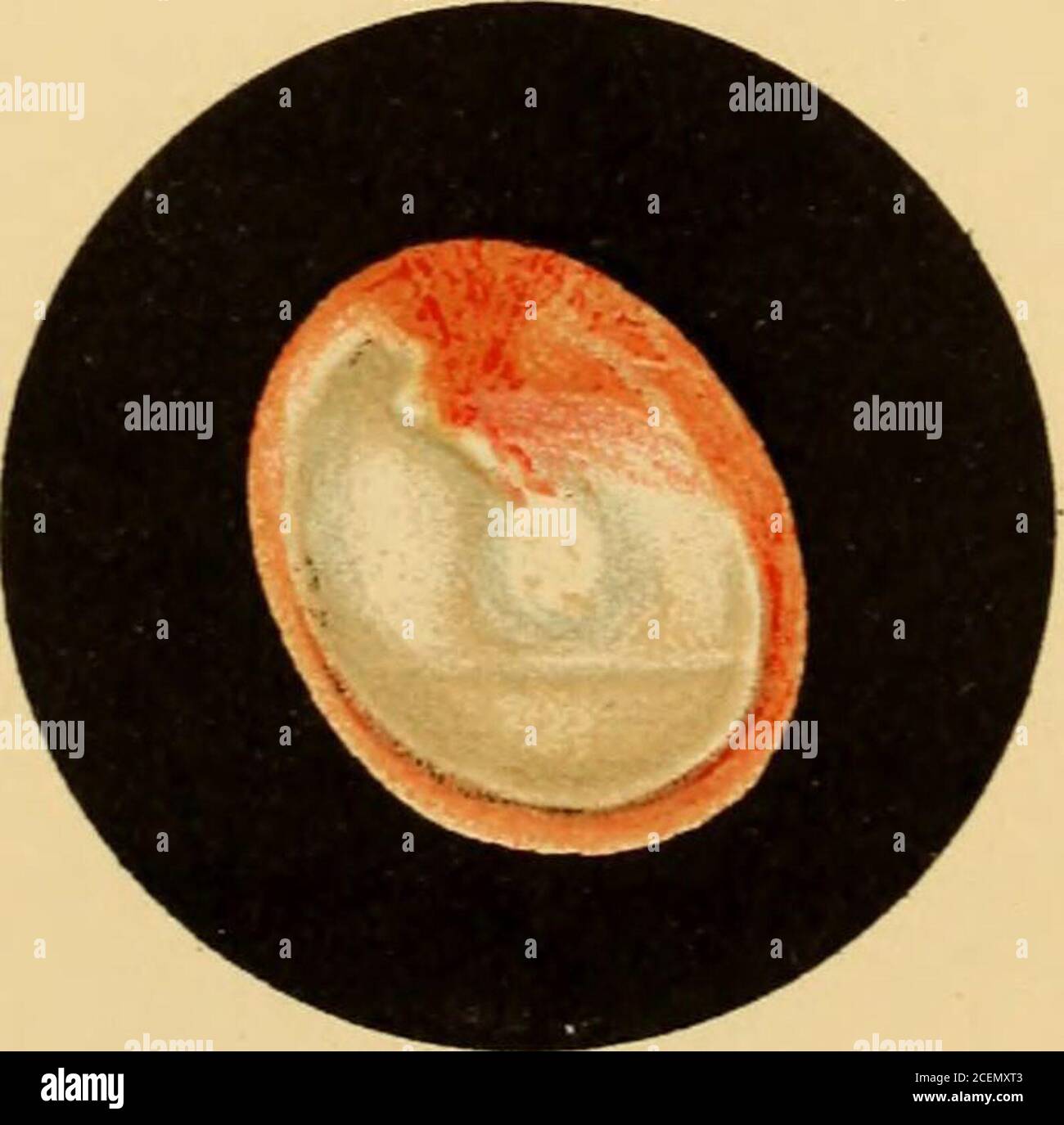 Tonsil membrane hi-res stock photography and images - Alamy