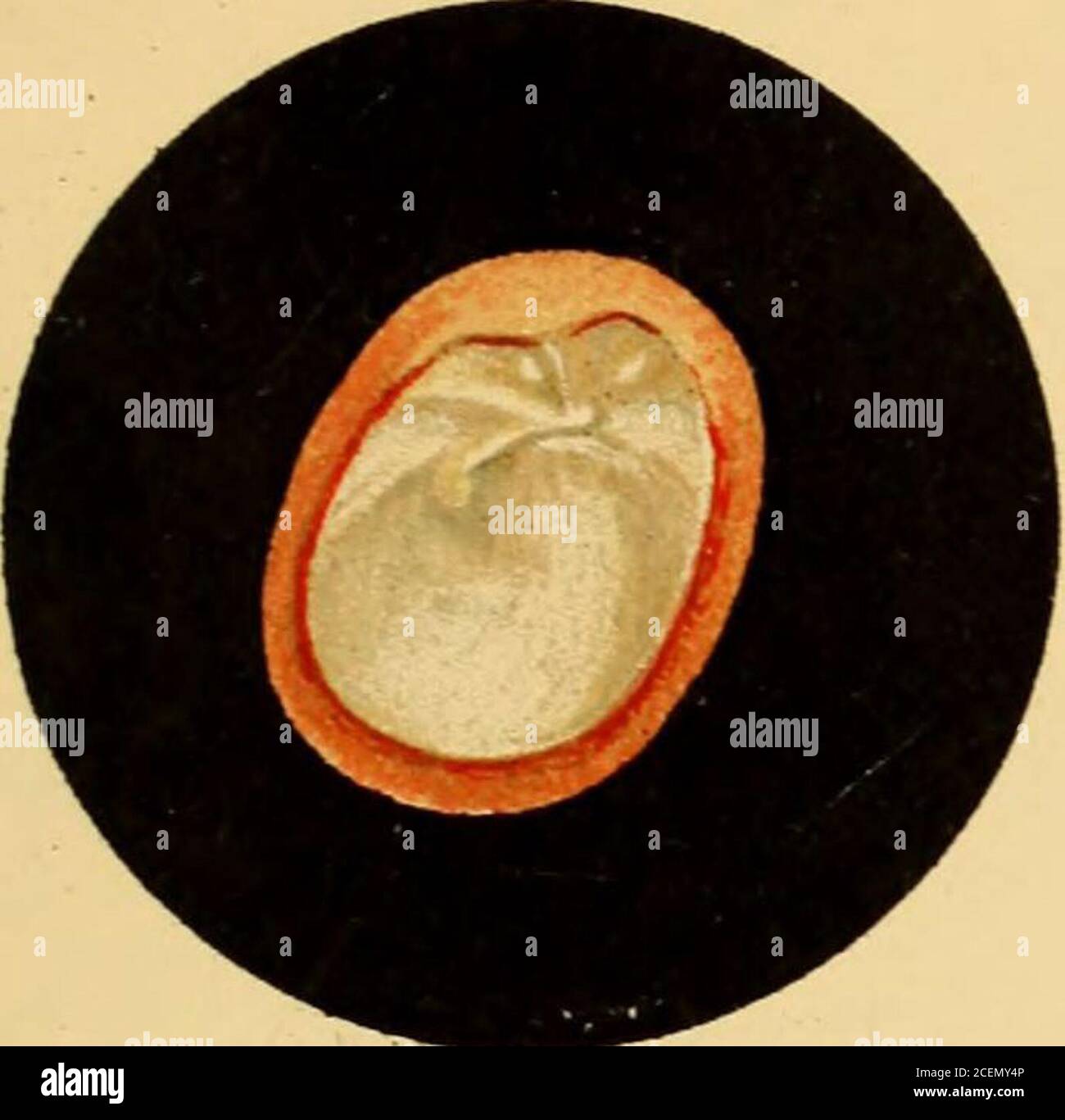 Tympanic membrane perforation hi-res stock photography and images - Alamy