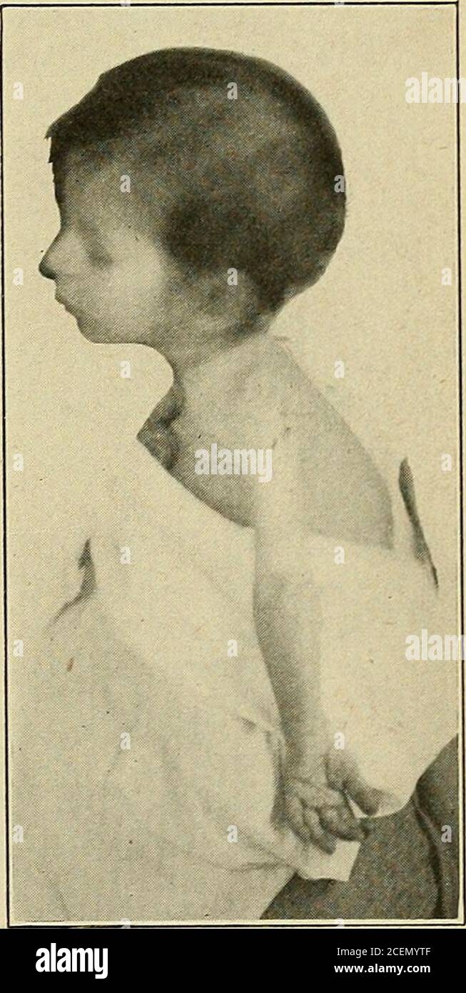 Erbs palsy hi-res stock photography and images - Alamy