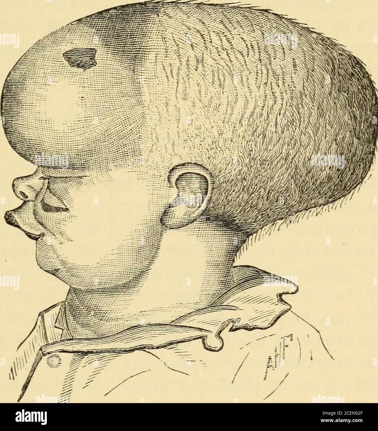 . The science and art of midwifery. 130.—Outline of head after delivery ...