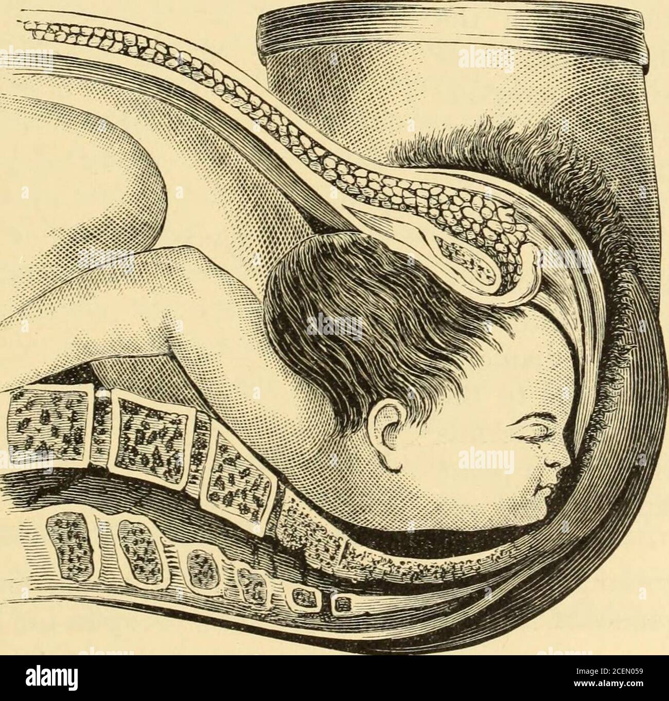 . The science and art of midwifery. Fig. 123.—Mechanism of face ...