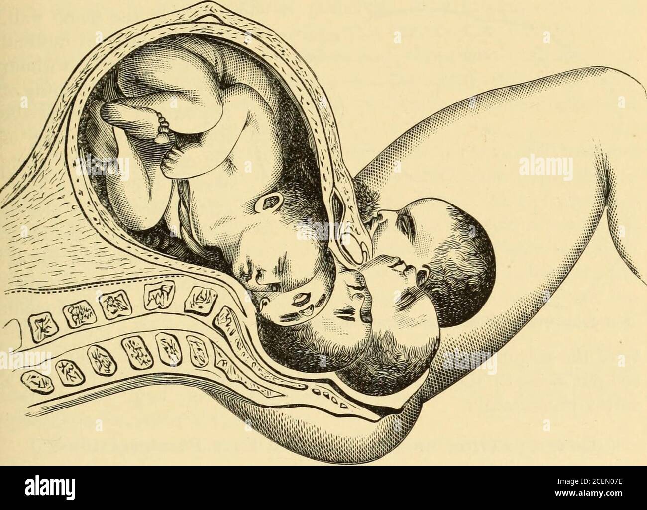 . The science and art of midwifery. Fio. 122.— Engagement of the head ...