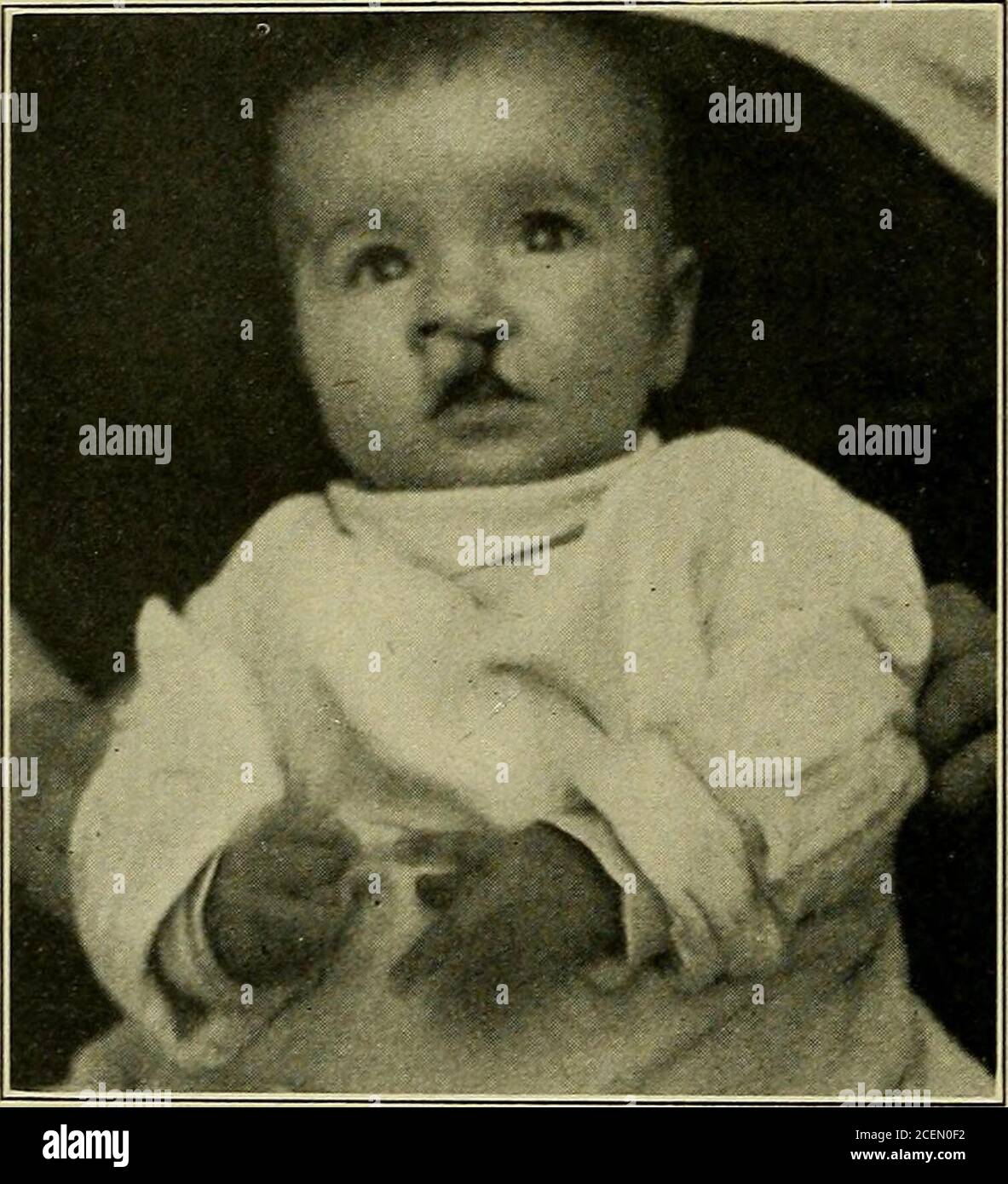 . Diseases of children. Fig. 11. -feeder. The Breck (Kirley.) 84 ...