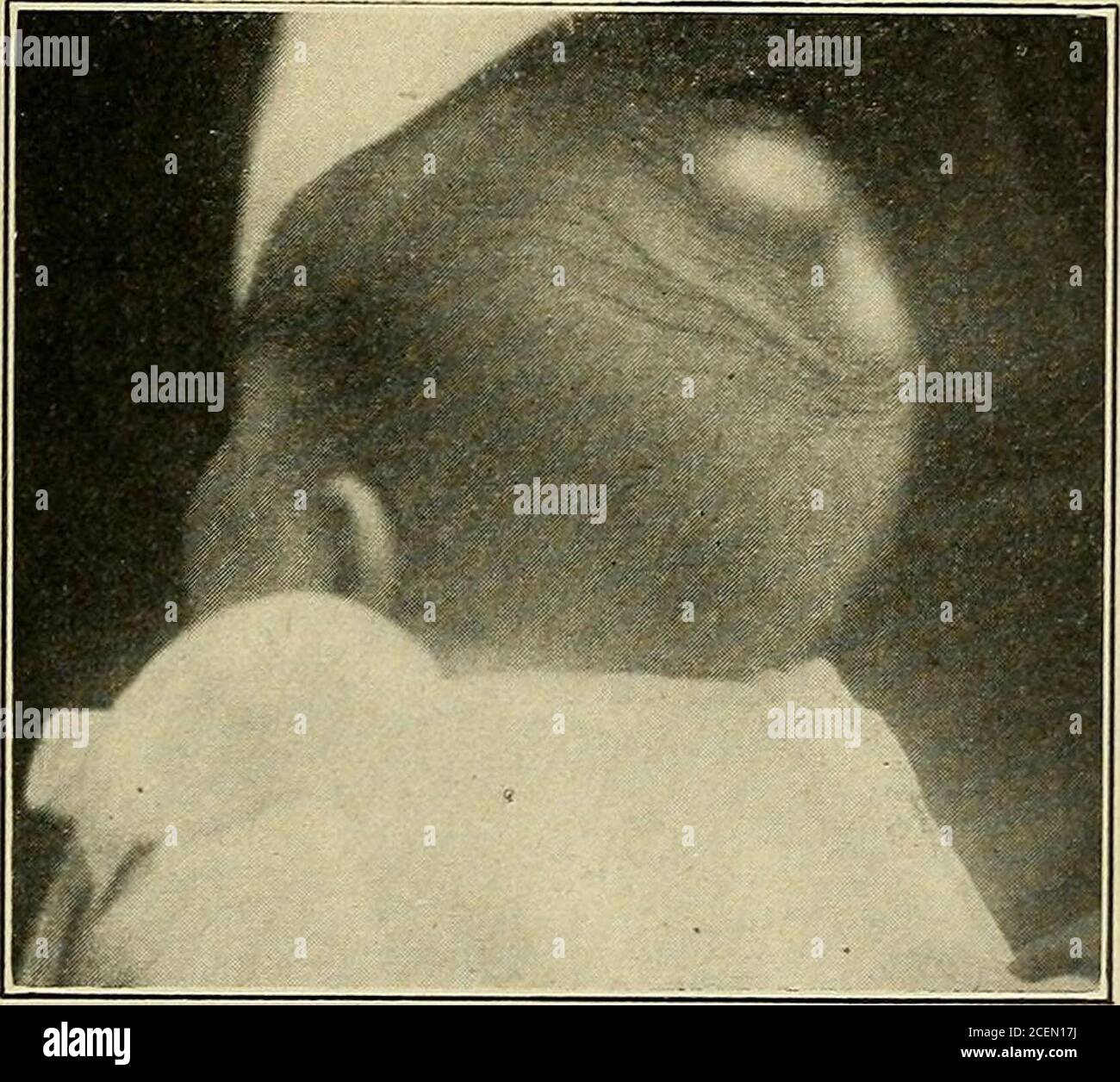 . Diseases of children. Fig. 2.—Meningocele in a child aged four months ...