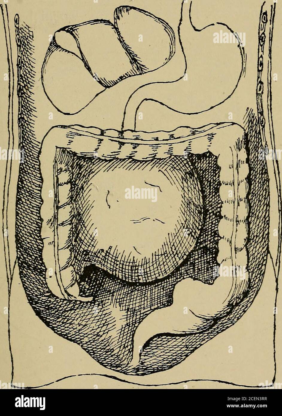 . On retro-peritoneal hernia : being the 'Arris and Gale' lectures on ...