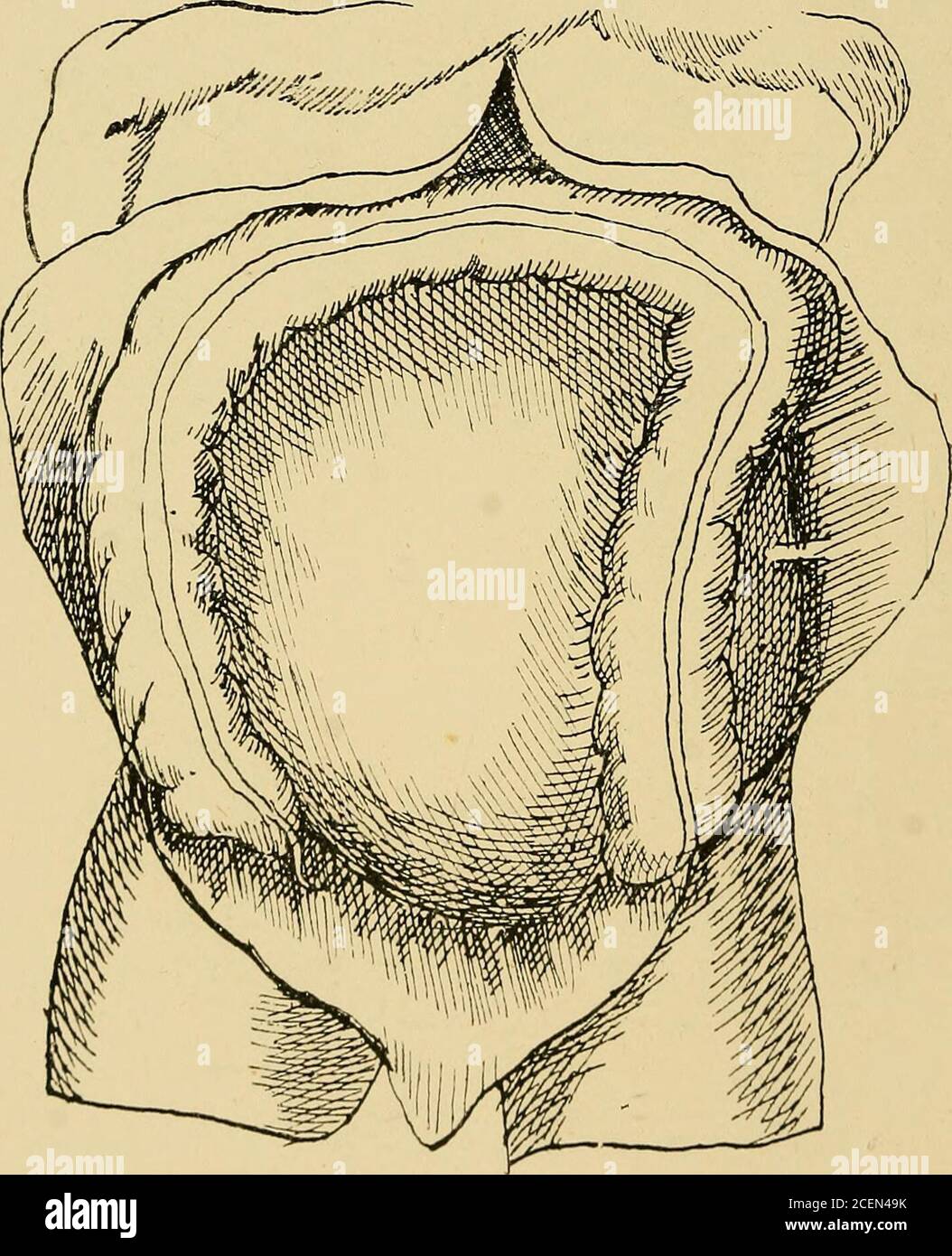 . On retro-peritoneal hernia : being the 'Arris and Gale' lectures on ...