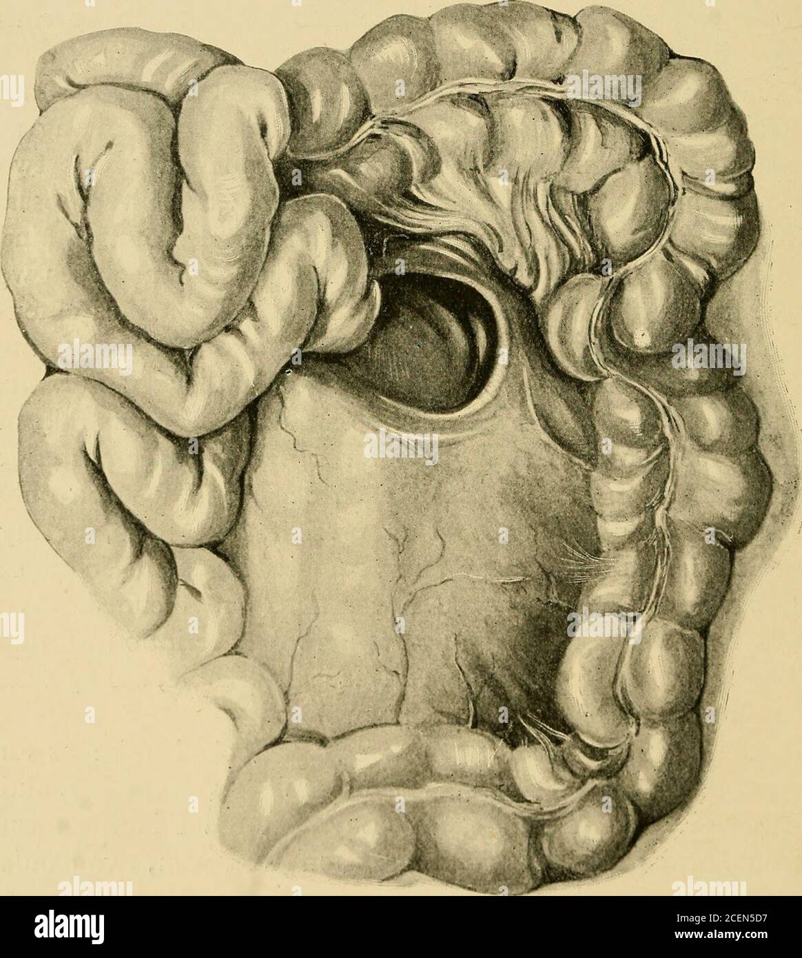 . On retro-peritoneal hernia : being the 'Arris and Gale' lectures on ...