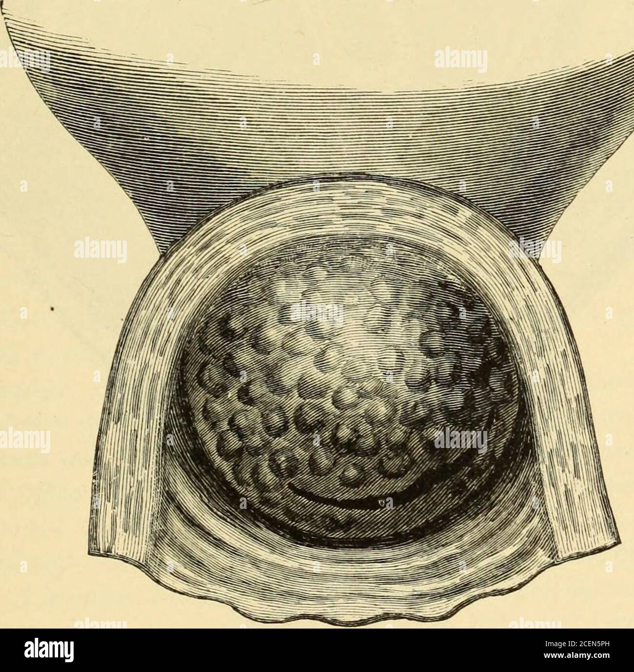 Canal of the cervix hi-res stock photography and images - Alamy