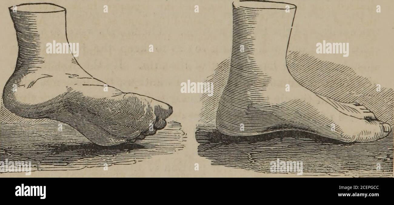 . Observations on lateral & angular curvature of the spine, wry-neck ...