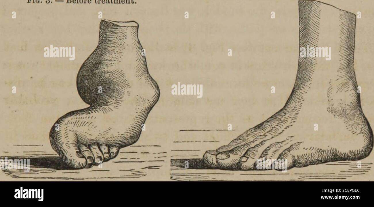 . Observations on lateral & angular curvature of the spine, wry-neck ...