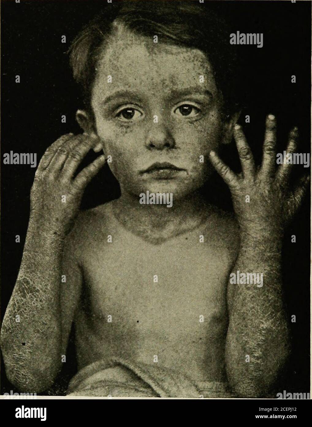 . The diseases of infancy and childhood. hat the eruption is receding ...