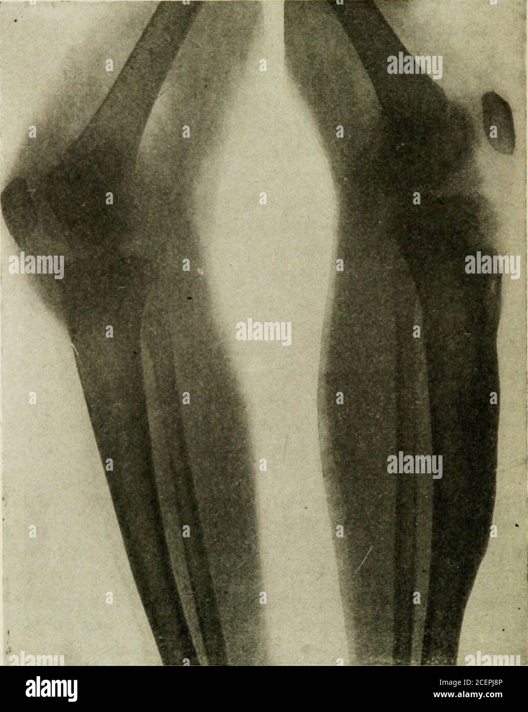 Suppurate High Resolution Stock Photography and Images - Alamy