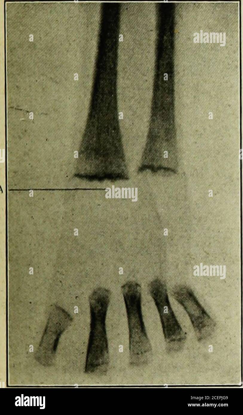 Osteoperiostitis hi-res stock photography and images - Alamy